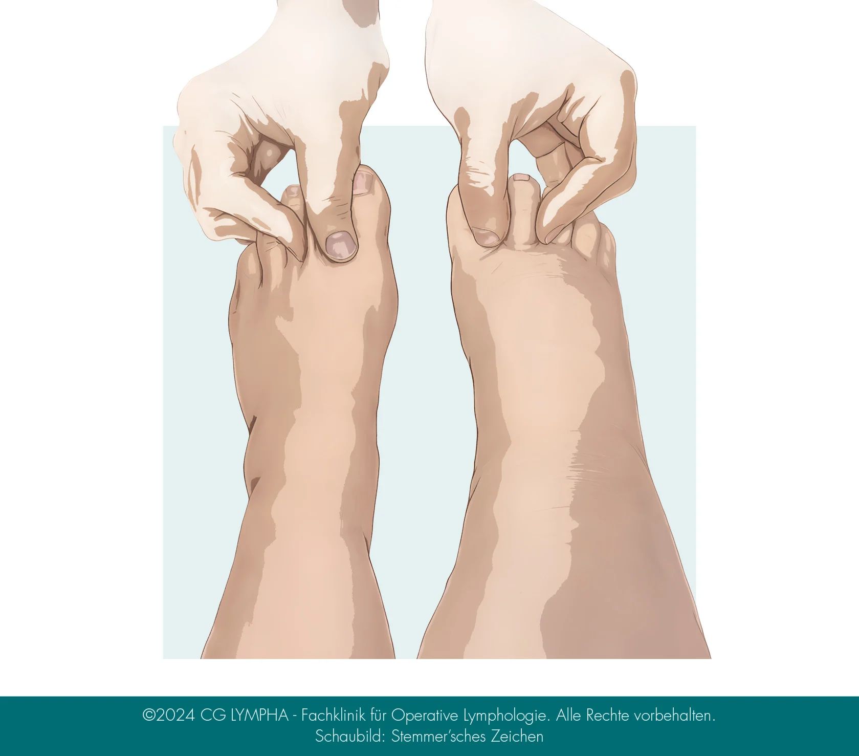 Lymphödem Symptome | CG Lympha